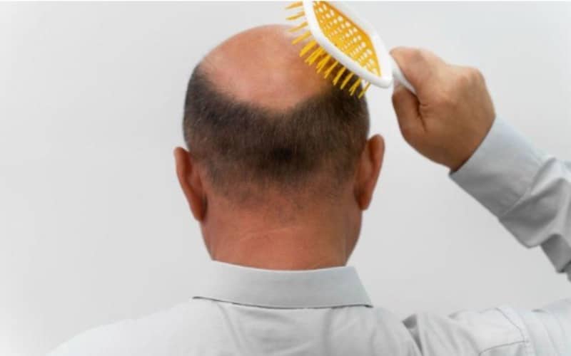 Comprehensive Guide to the Best Hair Loss Treatments for Men in 2024