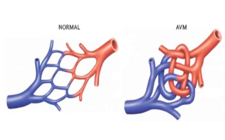 Understanding AVM Rupture: Causes, Symptoms, and Advanced Treatment Options